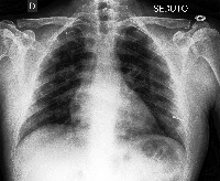 Corona Project - Roboflow Universe