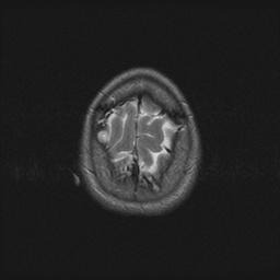 tumor Object Detection Model by test