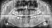 Training Tooth Imapction of Mandibular Third Molar (training-tooth ...