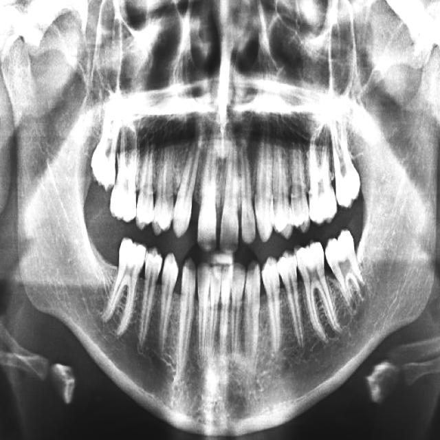 Ufba 425 Object Detection Dataset By Teeth Segmentation
