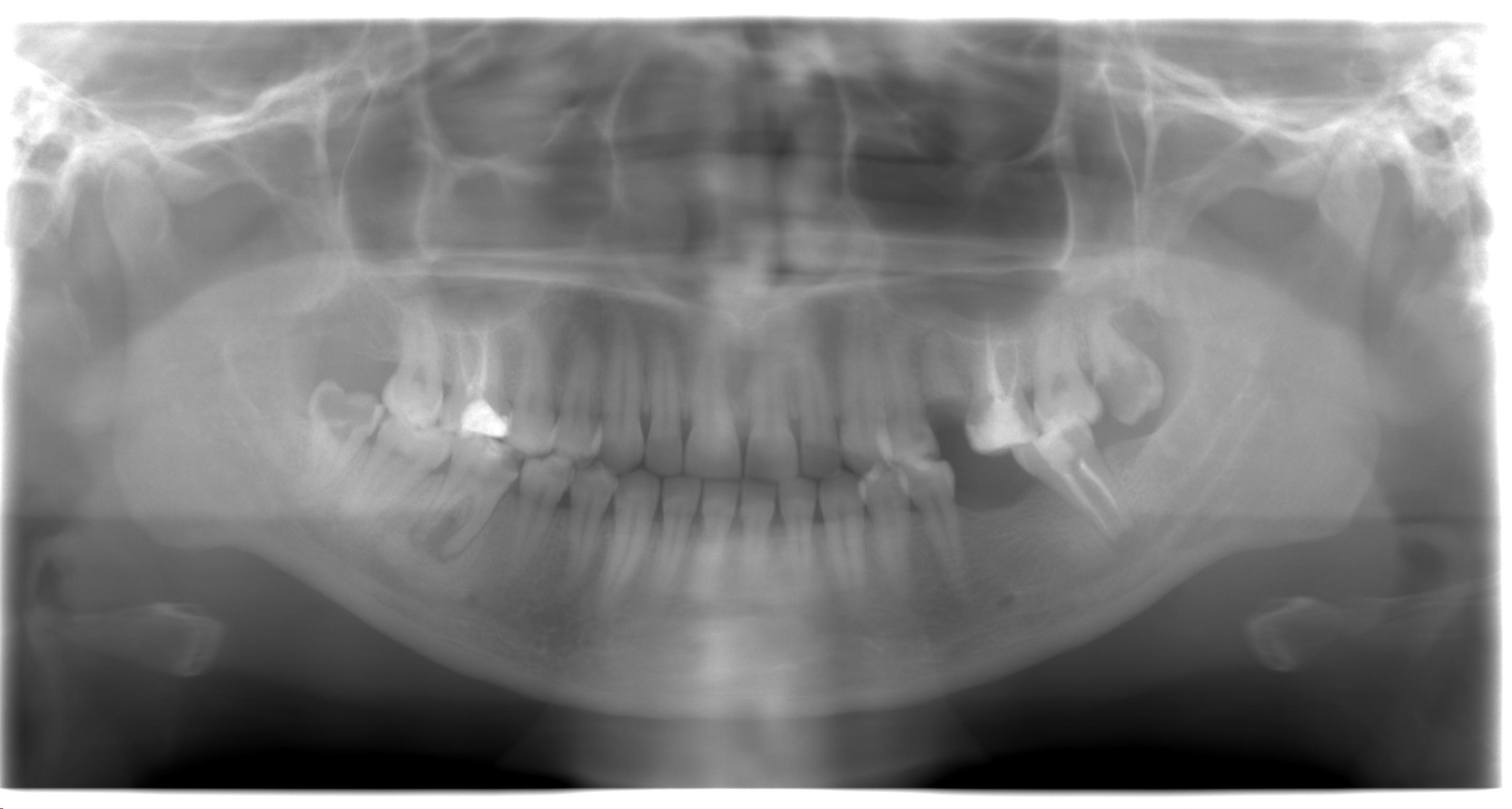 Dental Xray Dataset Roboflow Universe