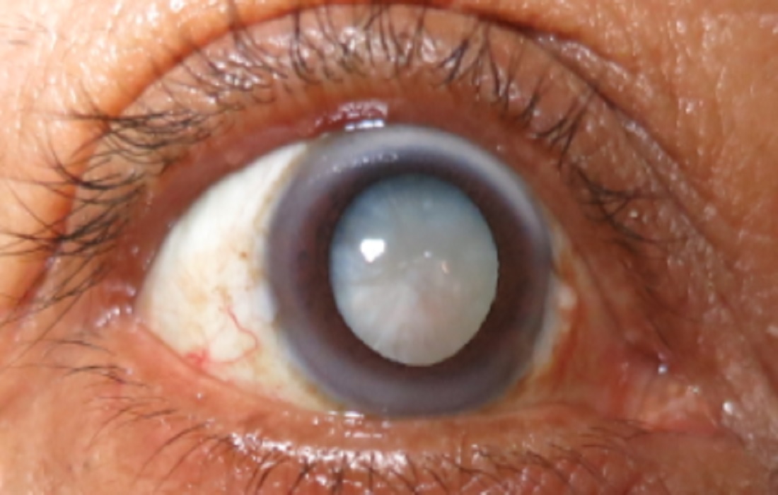 cataract-seg Instance Segmentation Dataset by yogi septiandri