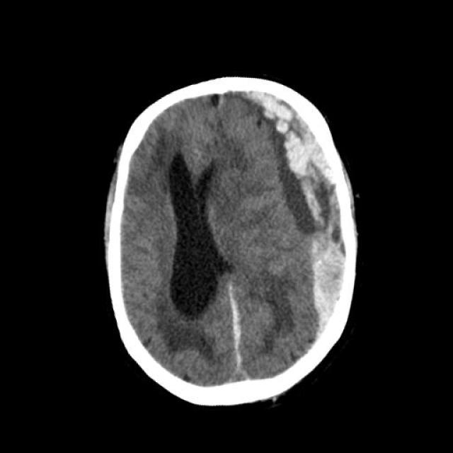SAH-detection Object Detection Model by Subarachnoid