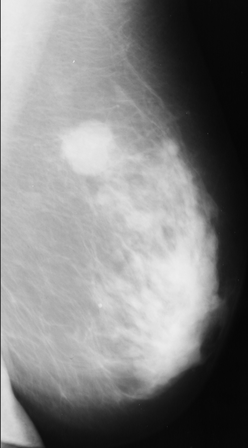 mammo (mammo-fvzst) - Roboflow Universe