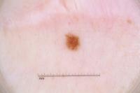 skin cancer (skin-cancer-l4jgb) - Roboflow Universe