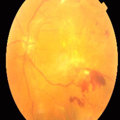 diabetic-retinopathy-detection Object Detection Dataset by fayez