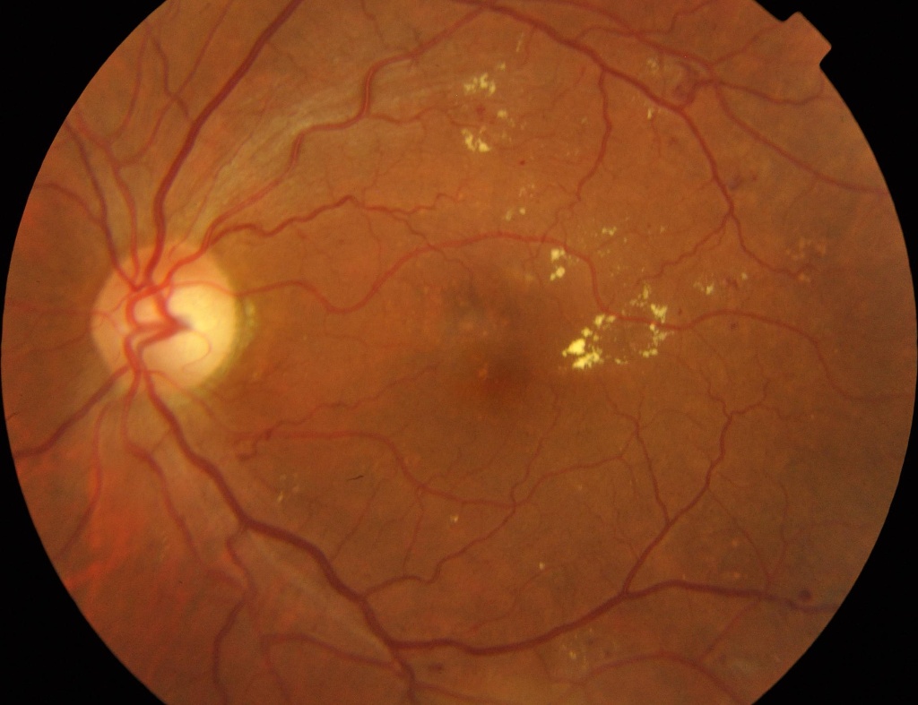 Dr Detection For Classification Instance Segmentation Dataset By Fayez