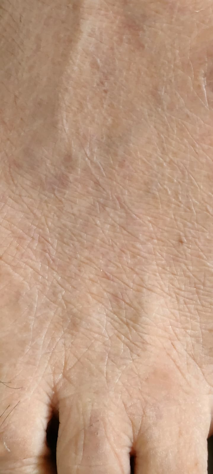Arsenic Skin Disease Object Detection Model by n1