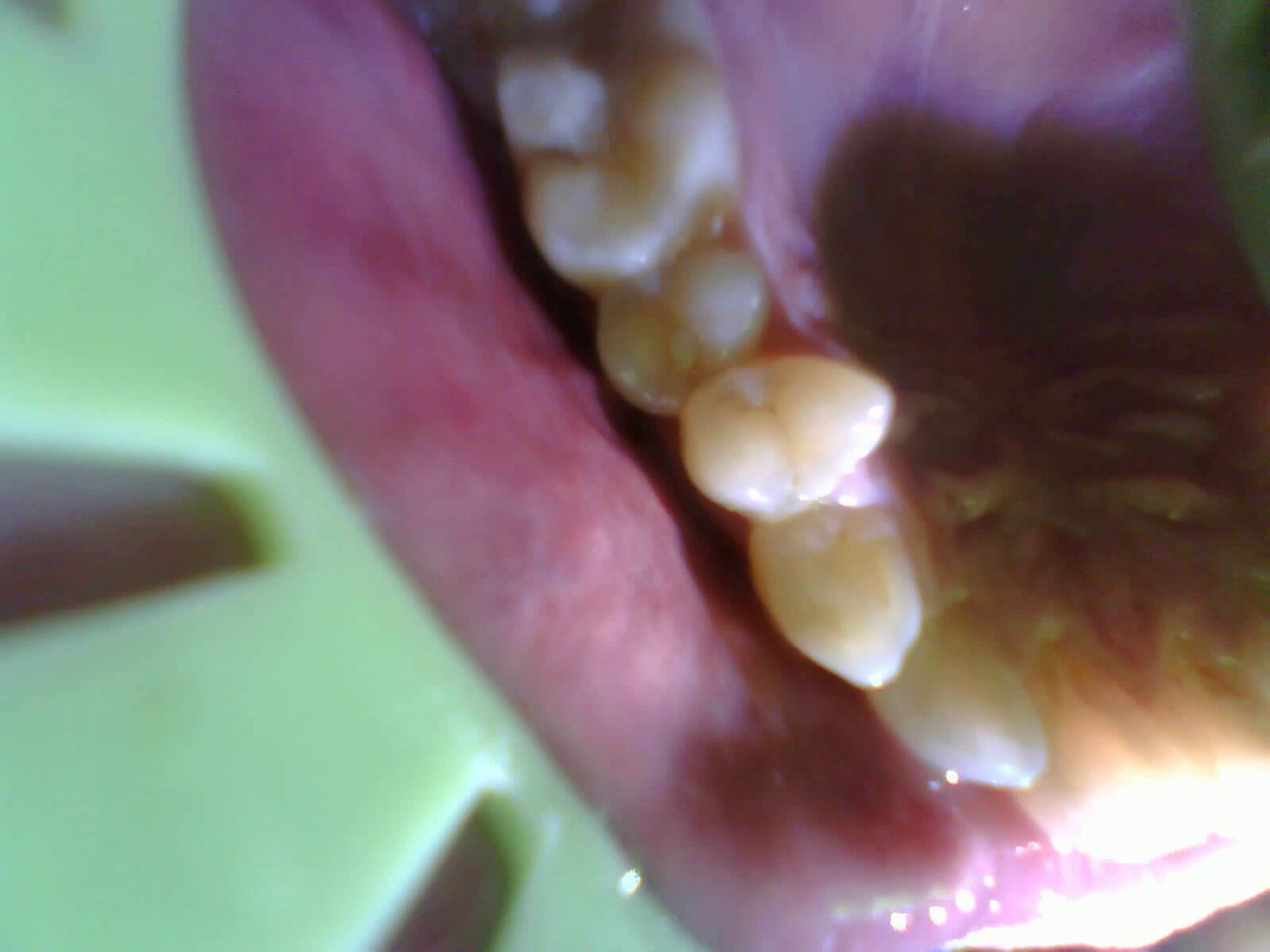 Oral-Cavity Object Detection Dataset by Sucharita