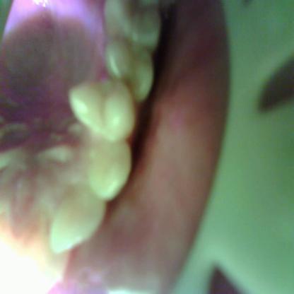 Intra-oral cavity detection Object Detection Dataset by Sucharita