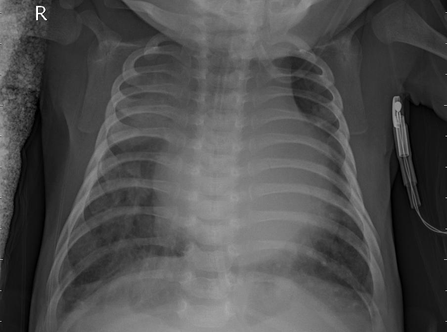 X-Rays Pneumonia Classification Dataset by Cubicasa