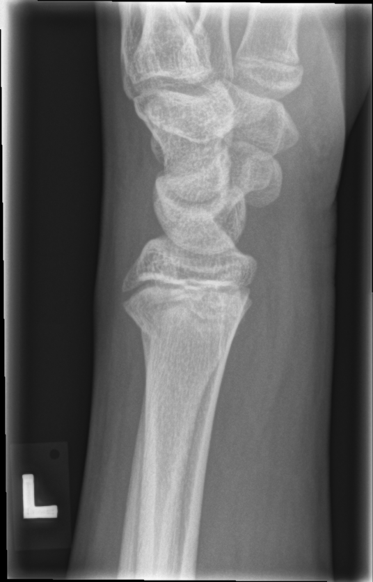 Wrist Lateral Radiograph Seg Instance Segmentation Model by Pongsakorn ...