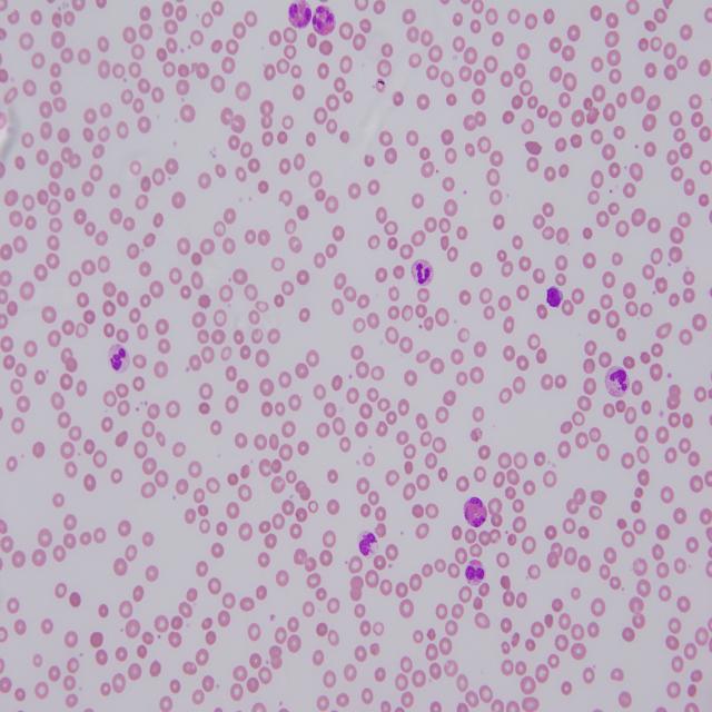 Thalassemia Object Detection Model by Thalassemia