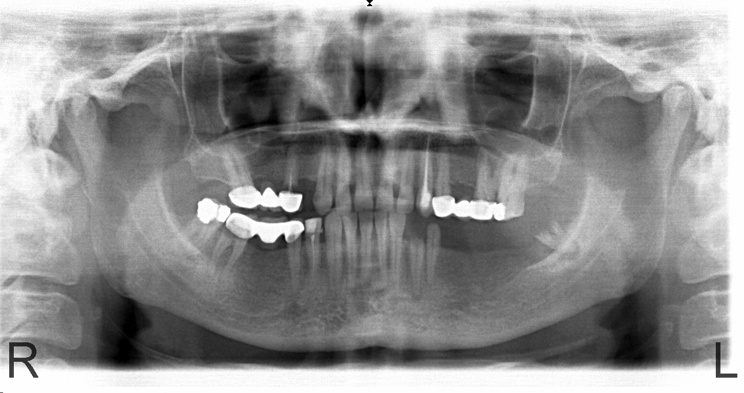 Tespit Teeth Object Detection Model By Last