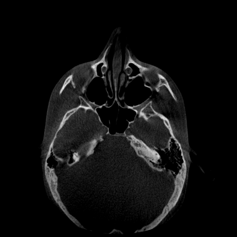 Afonina bones Instance Segmentation Dataset by tdm925