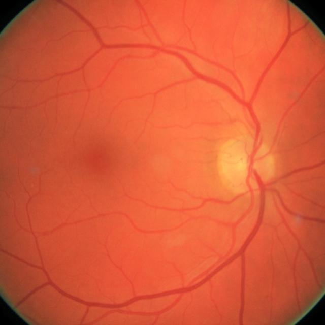 Eye Disease V8 Classification Dataset and Pre-Trained Model by King ...