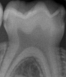 lower teeth Instance Segmentation Model by Pulp AI