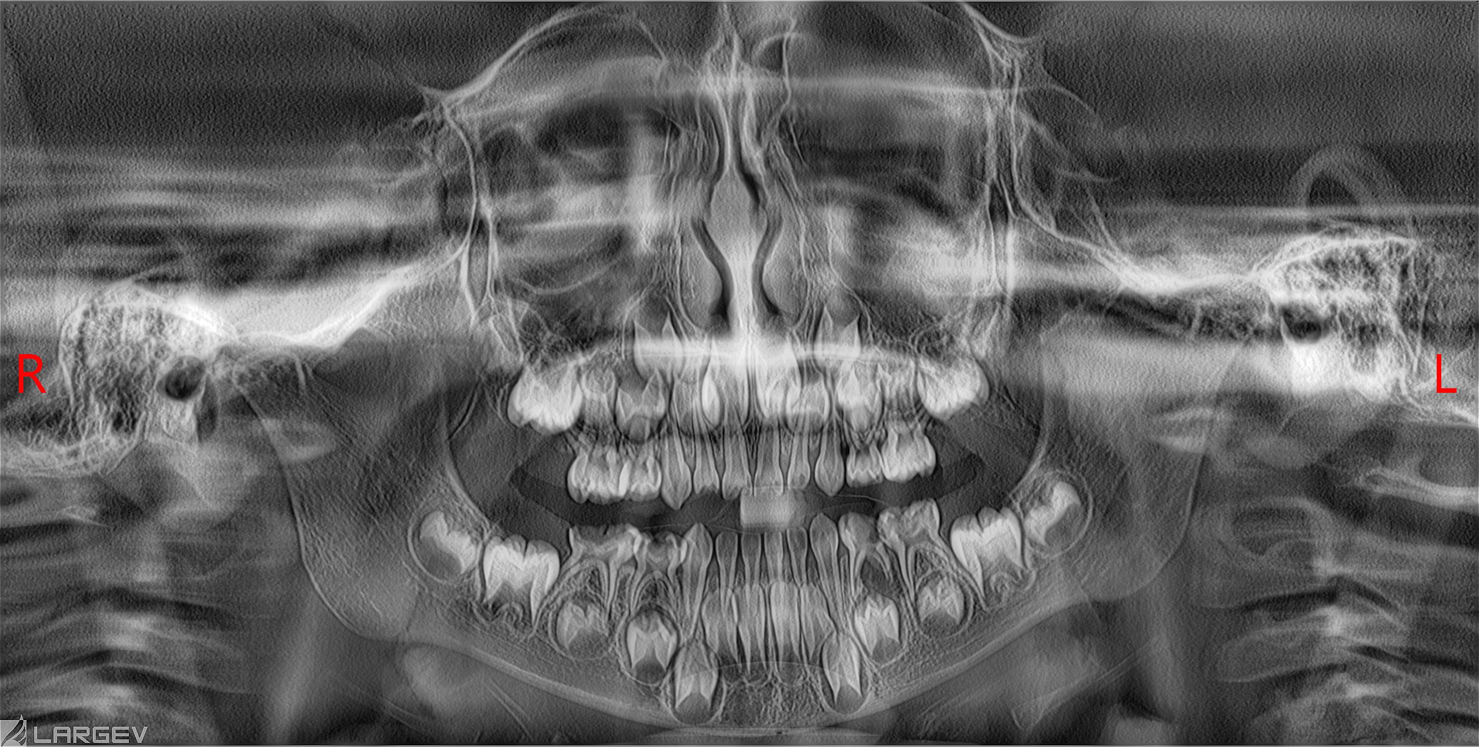 TOOTH Instance Segmentation Dataset by tooth