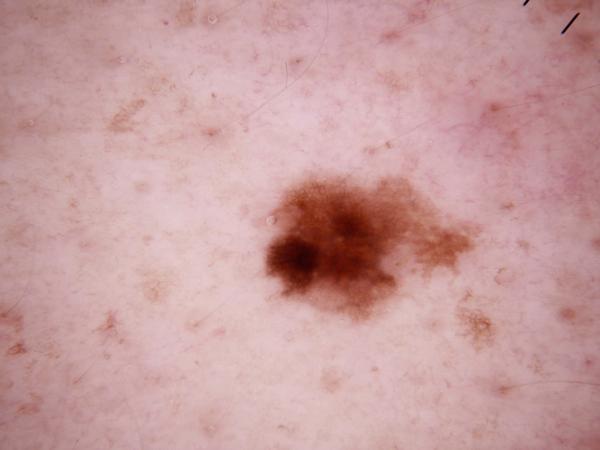 Nevus Classification Dataset by Scancer