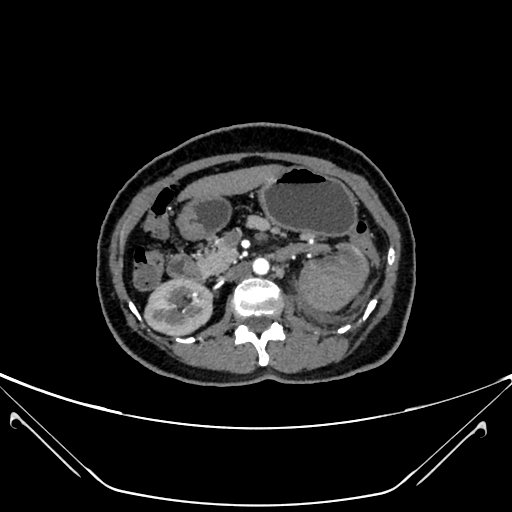 Kidney Stone Classification Model by Adnan khan