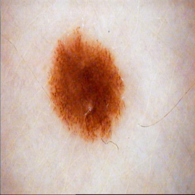 melanomaisicham Object Detection Dataset by Melanoma ISIC plus Ham