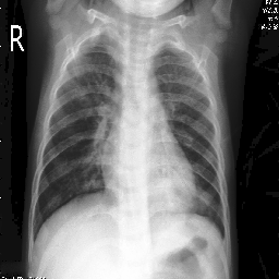 chest Classification Dataset by icvnz