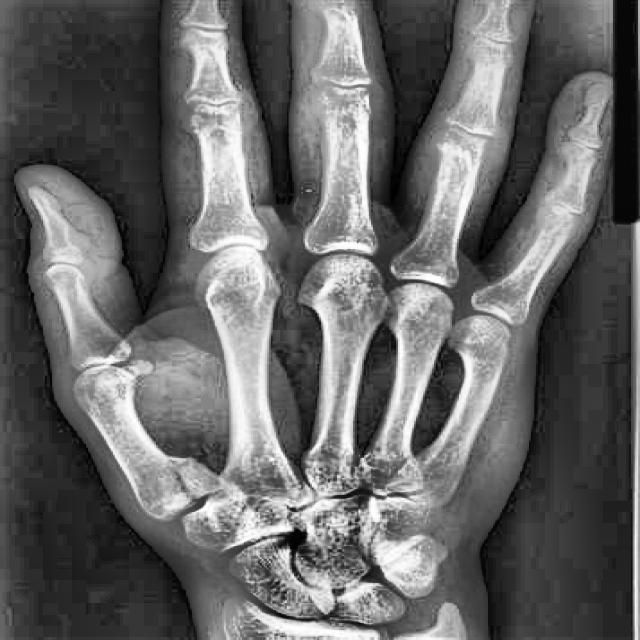 How to Use the FracBoneDts Instance Segmentation API