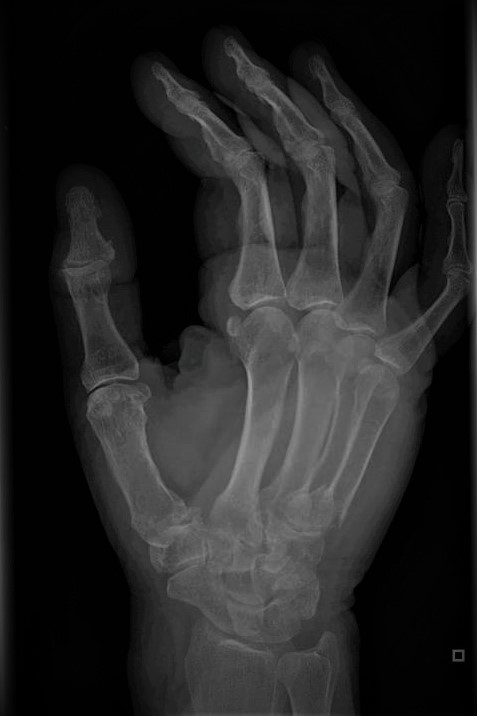 Seg2 Full Instance Segmentation Dataset By Bonefrac