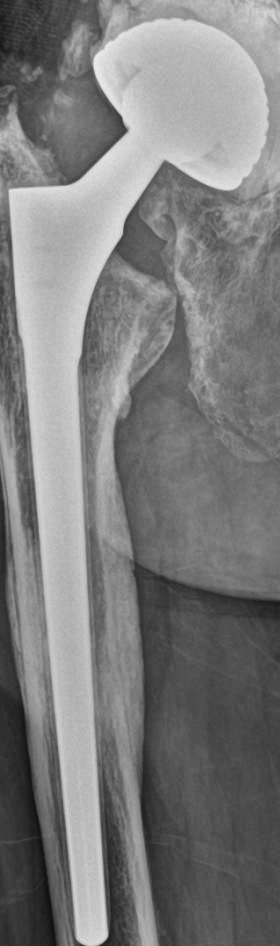 Cupangle2_CLAHE Instance Segmentation Dataset by Cup angle