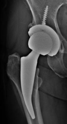 Cup angle2 Instance Segmentation Model by Cup angle