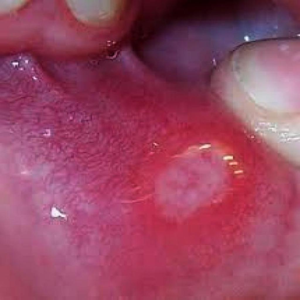 Oral Cancer Minerva Instance Segmentation Model (v5, 2025-04-13 7:18pm ...