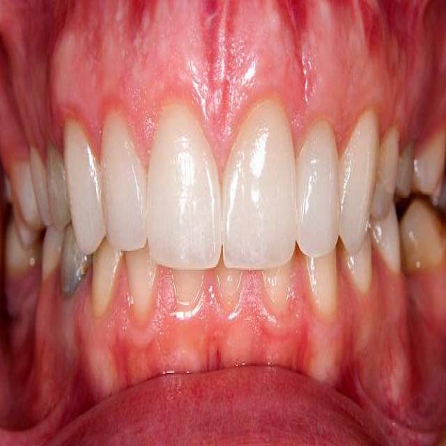 Gingival index segmentation2 Instance Segmentation Dataset by dental