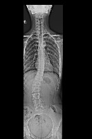 Bones cancer workspace - Roboflow Universe