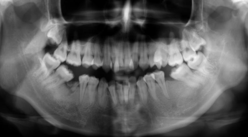 caries_segment Object Detection Model by ysm
