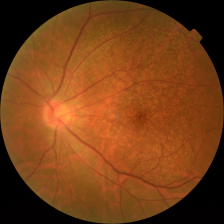 Retinal Disease Classification Classification Dataset and Pre-Trained ...