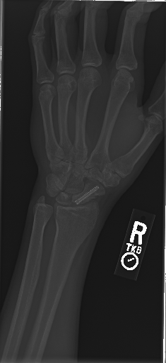 Bone Fracture Detection Object Detection Dataset By Yolov8