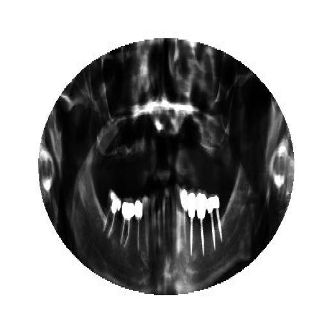 Only Caries Object Detection Dataset And Pre Trained Model By Zaxo