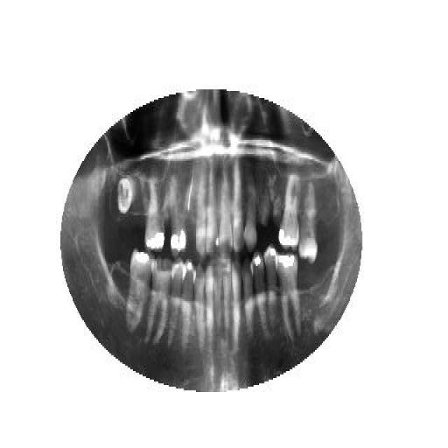 Caries Object Detection Dataset By Zaxo