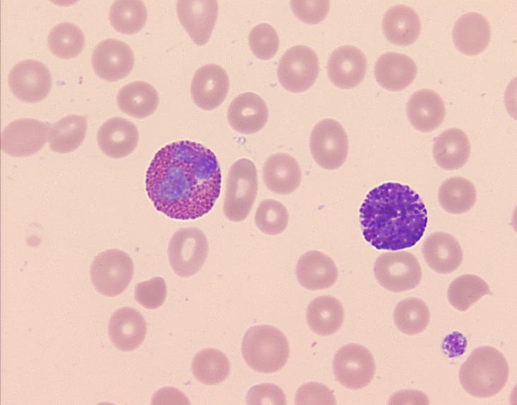 Leukemia Detection Object Detection Dataset By New Workspace Iy2aw