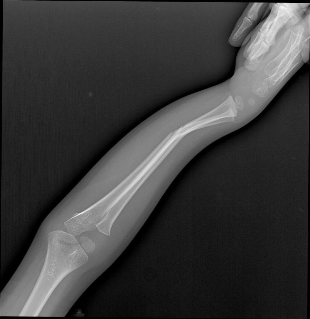 Bone Fraction Detection Object Detection Dataset By Project