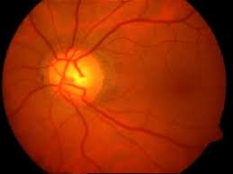 Glaucoma Detection Object Detection Dataset and Pre-Trained Model by eye
