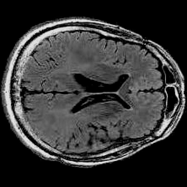 Brain Tumor V1 Object Detection Dataset And Pre Trained Model By