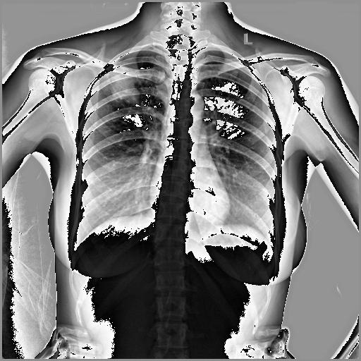 chest-xray-v1 Instance Segmentation Dataset by braintumordetection