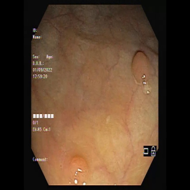 Polyp Detection Object Detection Model (v8, 2025-06-19 11:08am) by ...