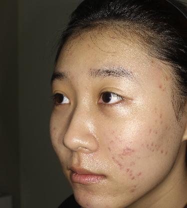 dataset Object Detection Dataset by ACNE DETECTION