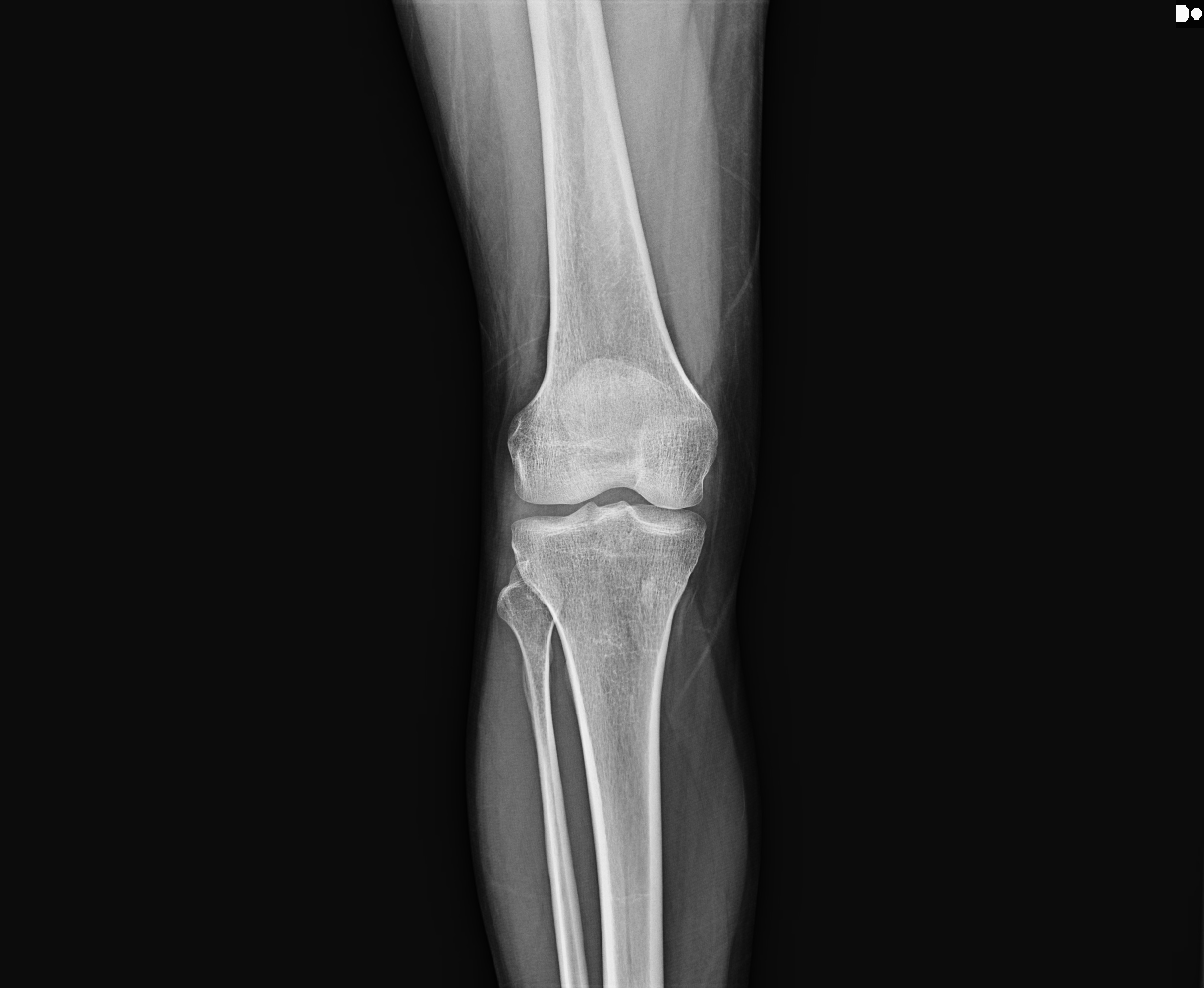 knee X-ray Object Detection Model by MultiClass Knee Osteoporosis XRay