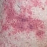 Rash/Lesion Detection Object Detection Model by SekyuTech 1