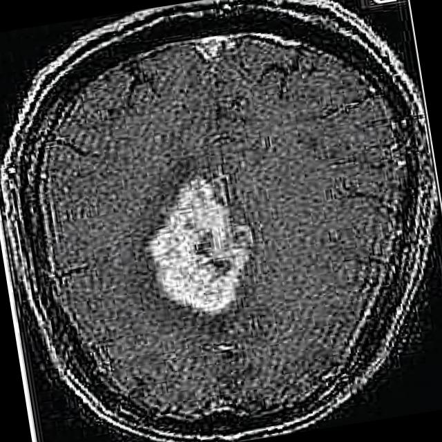 Brain Tumor Detection Object Detection Dataset And Pre Trained Model By