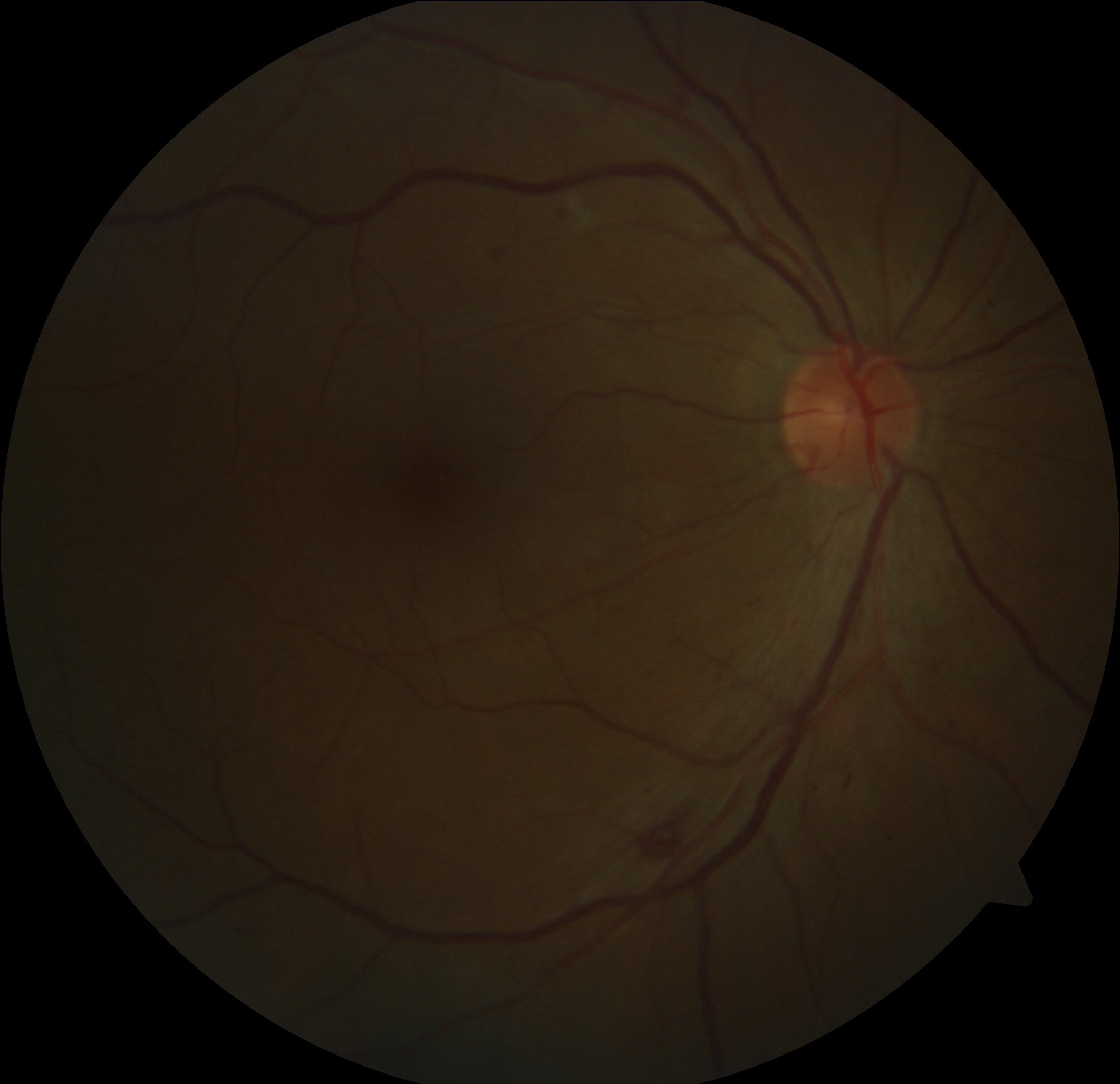 Diabetic Retinopathy Object Detection Model by project