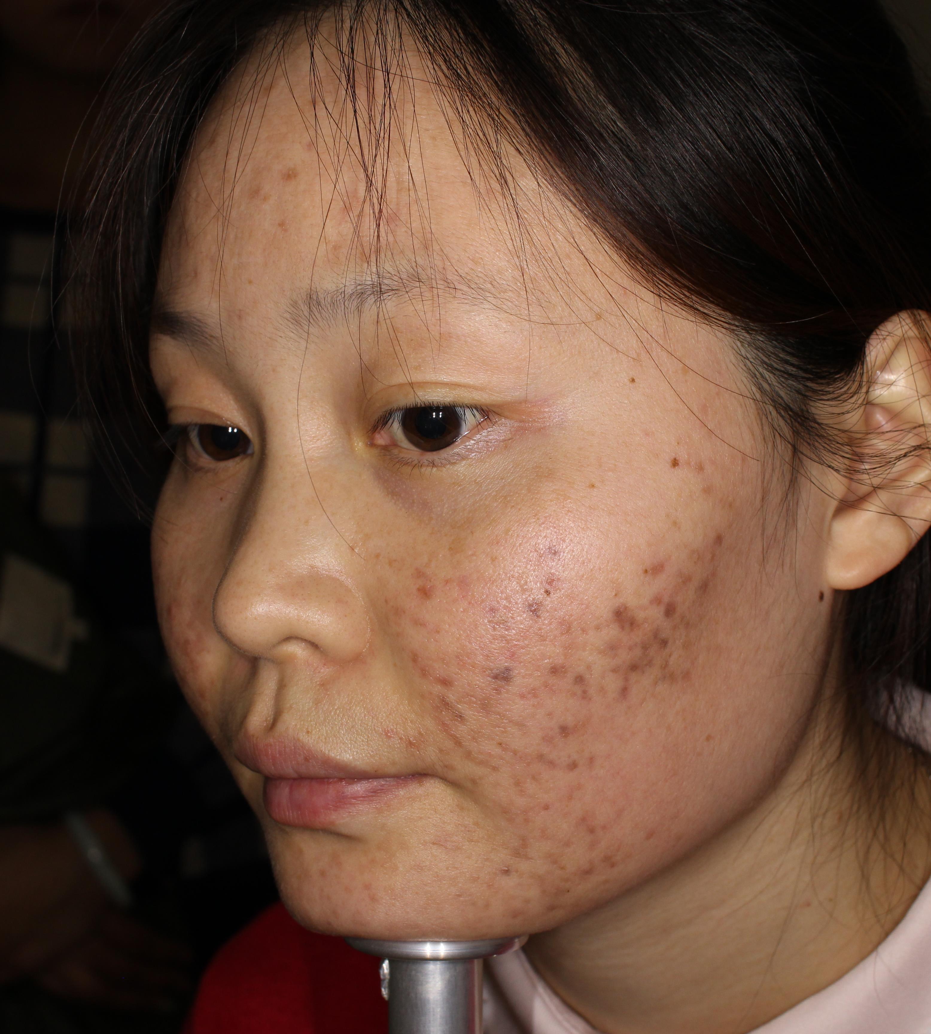 Acne04 Object Detection Model By Acne04